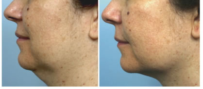 Double Chin | Flabby Jowls | Loose Skin | Double Chins | PERFECT FACE ...