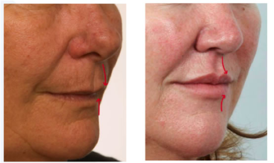 Ageing Lips | Old Lips | Thin Lips | Mouth Frown | PERFECT FACE ...