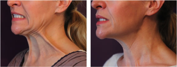 Ageing Neck Treatents at PERFECT FACE | Facial LASER Aesthetics Clinic ...