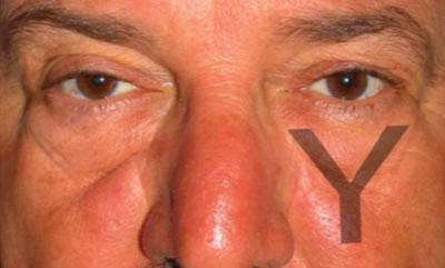 Volume Loss | Loss of Volume in Face | Facial Volume Loss | PERFECT ...