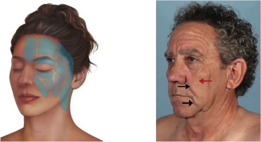 Hollow Cheeks | Sunken cheeks | Indented Cheek | PERFECT FACE | Facial ...