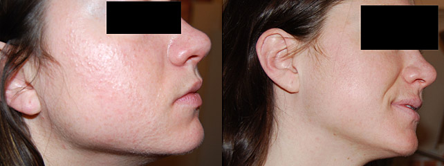 Dermaroller | PERFECT FACE | Facial LASER Aesthetics Clinic | Portimao ...